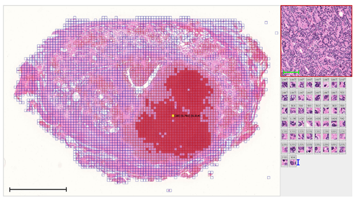 Weakly Supervised Learning Unlocks Medical Imaging Insights | Mouser